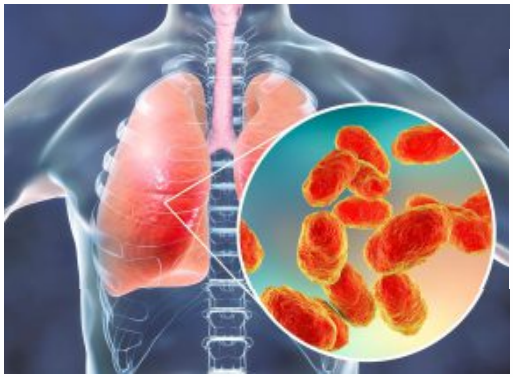 Pneumococcal Disease Pneumonia Vaccine PNEUMOSIL 