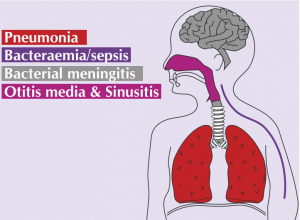 Pneumococcal Disease | Pneumonia Vaccine | PNEUMOSIL®